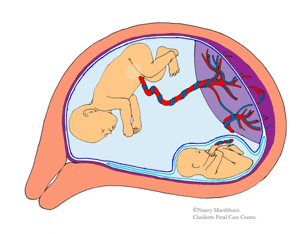 Twin to Twin Transfusion Syndrome (TTTS) – The Patient Mom